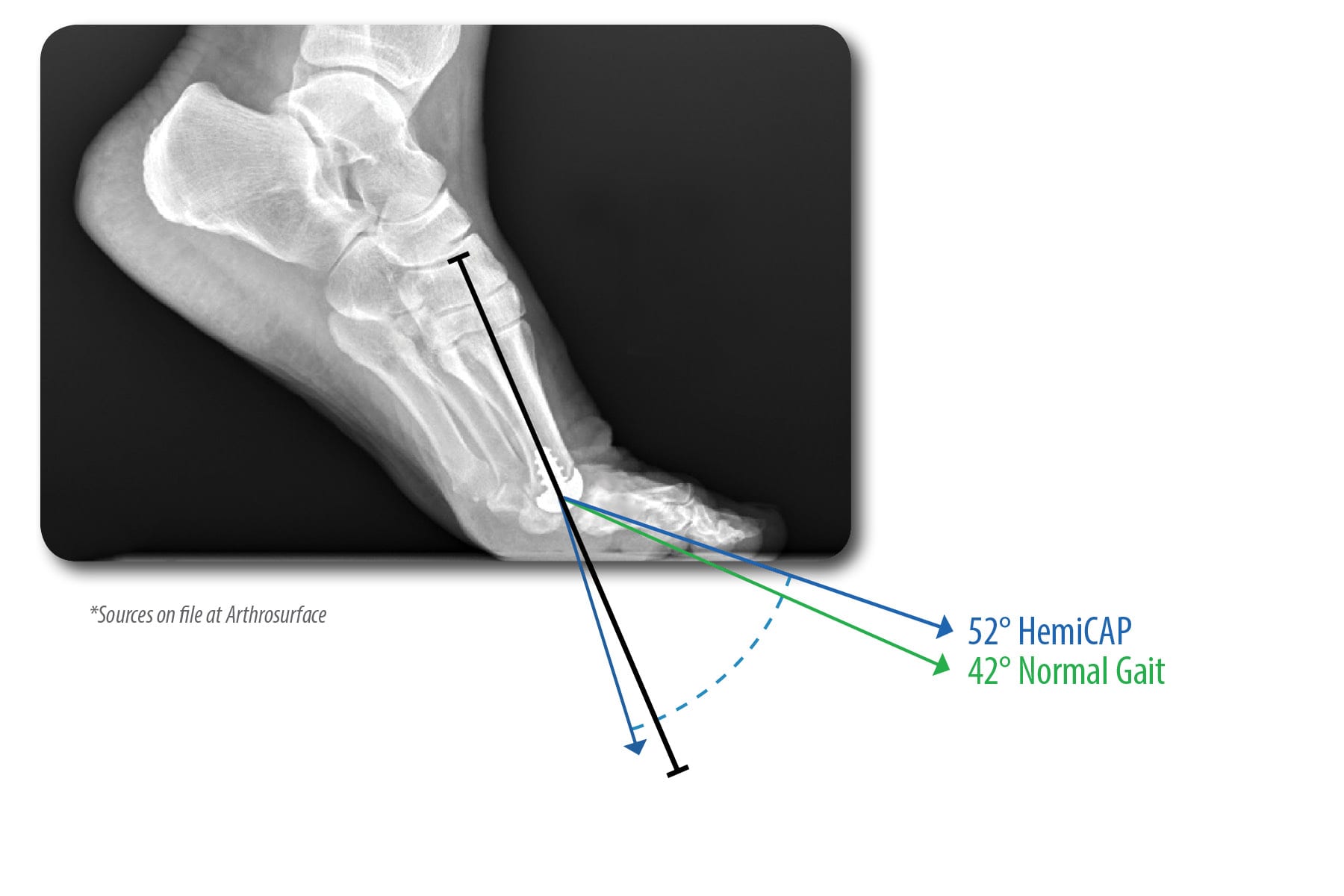 MTP Joint Pain & Hallux Rigidus Treatment | Arthrosurface