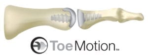 ToeMotion and HemiCAP Toe Implants | Arthrosurface