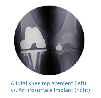 Knee Implants- PF HemiCAP® Classic, PF Wave® & WaveKahuna™