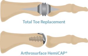 ToeMotion and HemiCAP Toe Implants | Arthrosurface