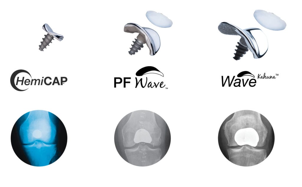 Knee Implants- PF HemiCAP® Classic, PF Wave® & WaveKahuna™
