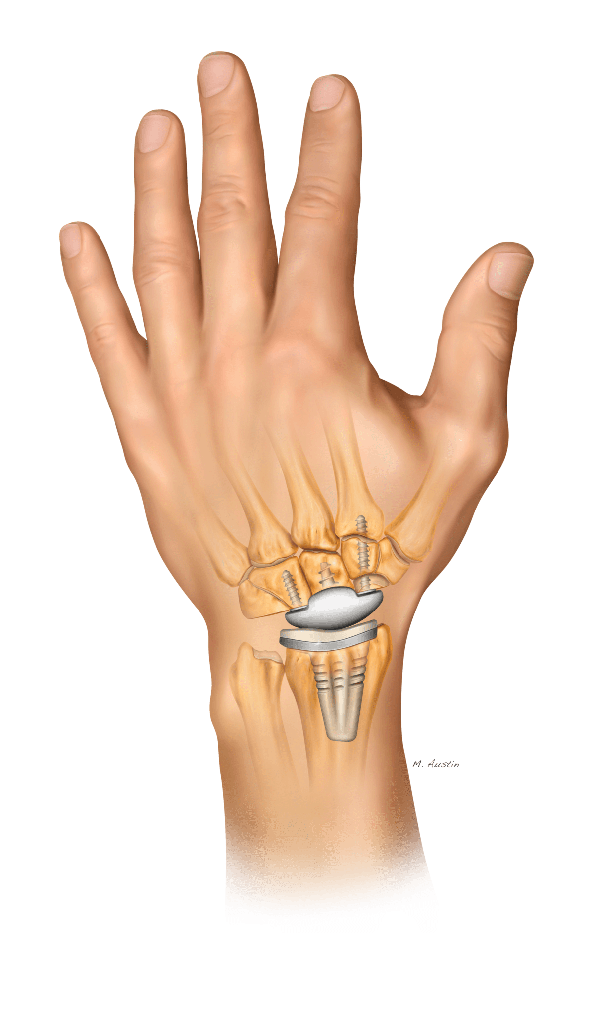 Upper Extremity- WristMotion® Hemiarthroplasty Implant System